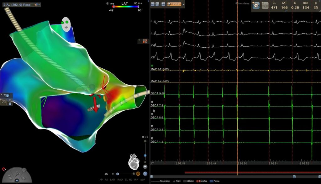 Clinical Cases - Cardiac Anatomy for Electrophysiologist