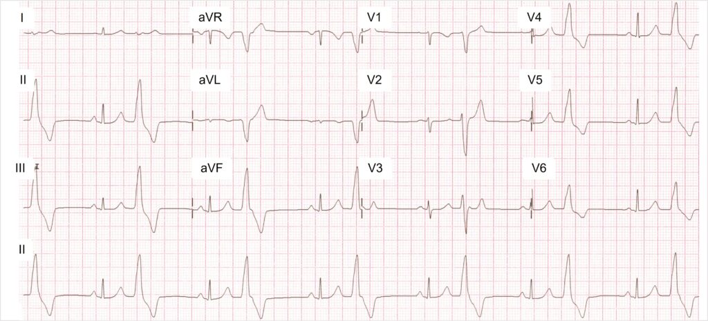 Ablation of idiopathic premature ventricular contractions originating ...