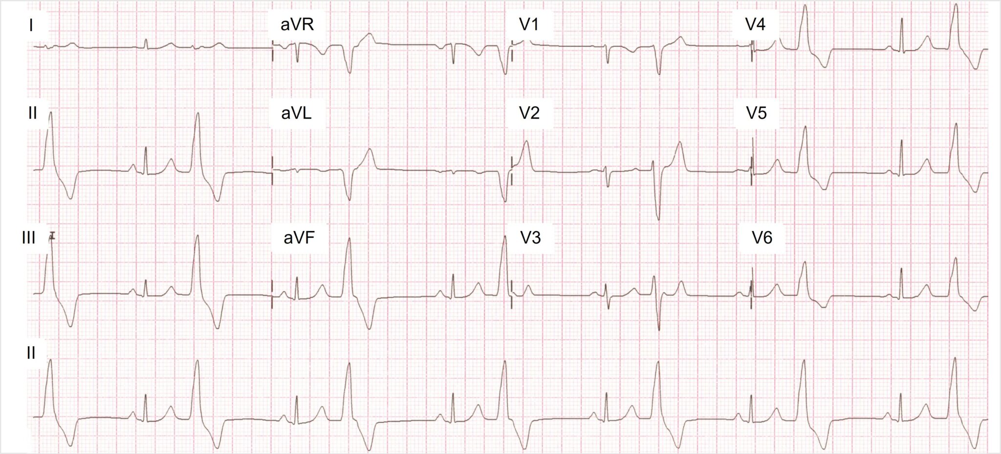 Ablation of idiopathic premature ventricular contractions originating ...