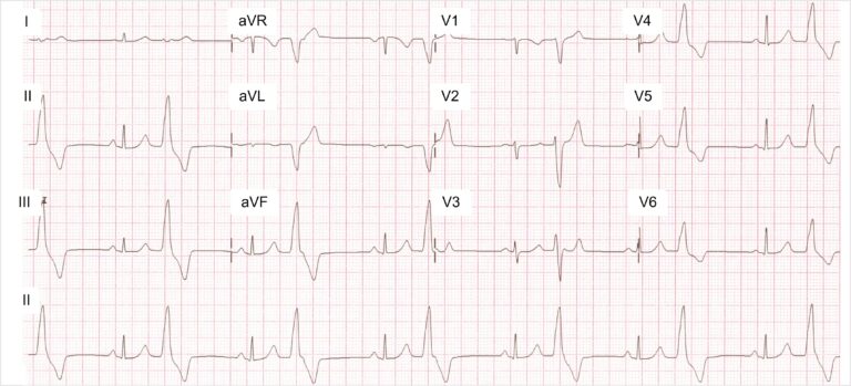 Ablation of idiopathic premature ventricular contractions originating ...