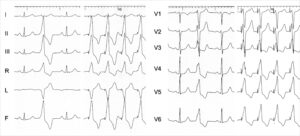 Ablation of idiopathic premature ventricular contractions originating ...