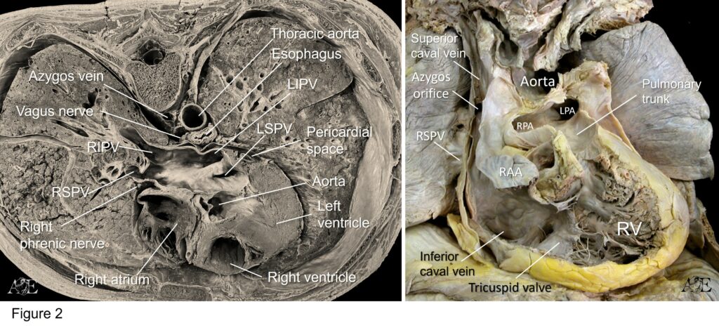 Atlas - Cardiac Anatomy for Electrophysiologist