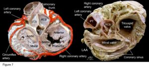 Atlas - Cardiac Anatomy for Electrophysiologist