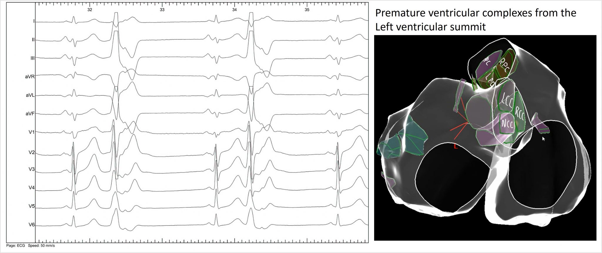Left Ventricular summit for ablation - Cardiac Anatomy for Electrophysiologist