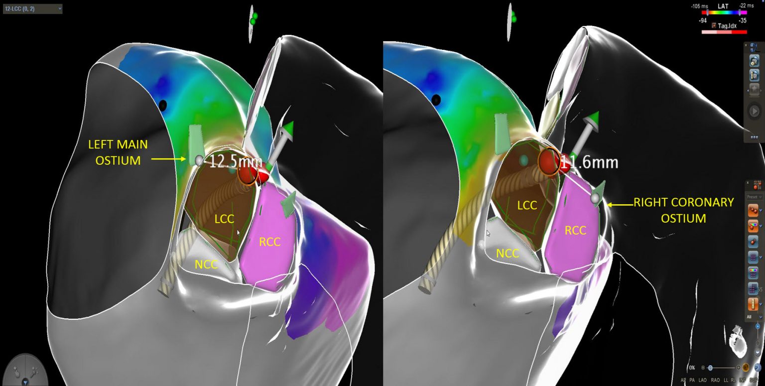 Left Ventricular summit for ablation - Cardiac Anatomy for ...