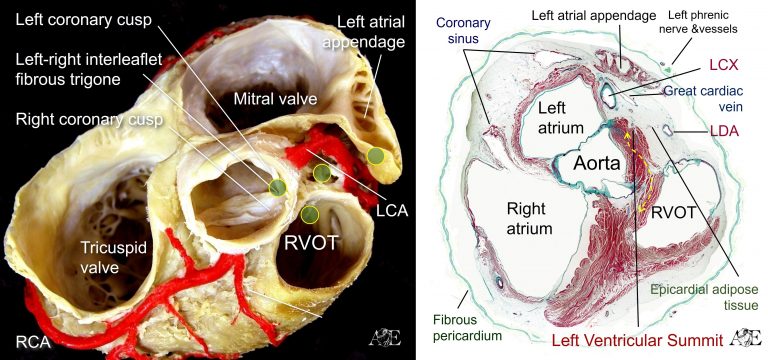Left Ventricular summit for ablation - Cardiac Anatomy for Electrophysiologist