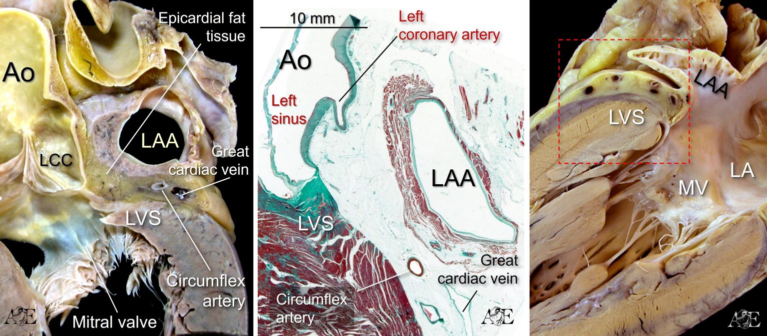 Left Ventricular summit for ablation - Cardiac Anatomy for ...