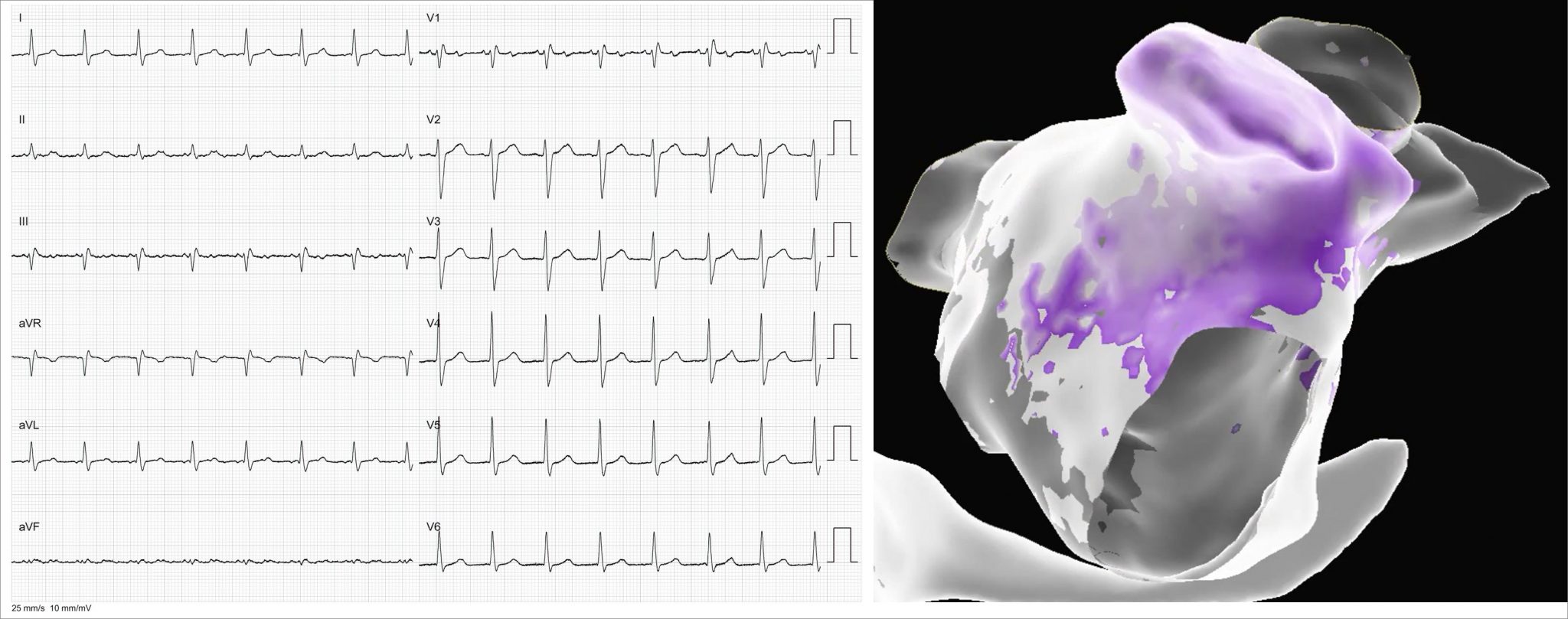 Iatrogenic biatrial flutter. The role of the Bachmann’s bundle ...
