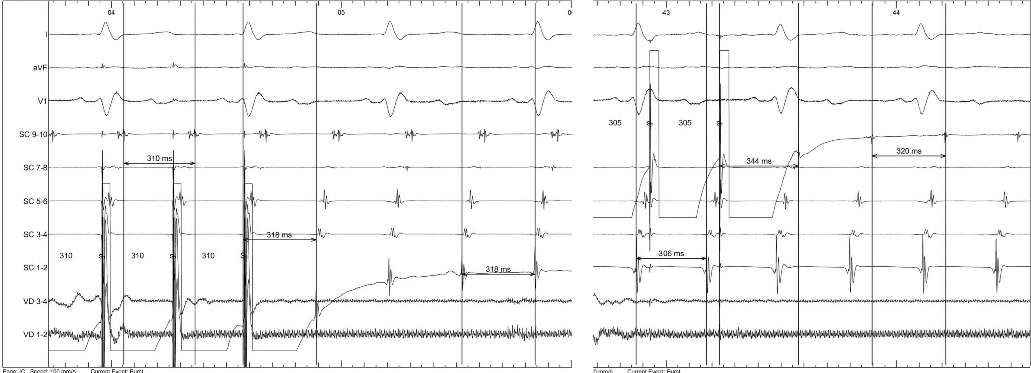 Iatrogenic biatrial flutter. The role of the Bachmann’s bundle ...