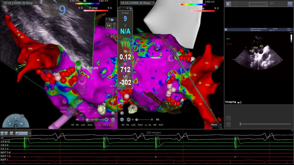 Zero fluoroscopy technique for atrial fibrillation ablation: Step guide ...