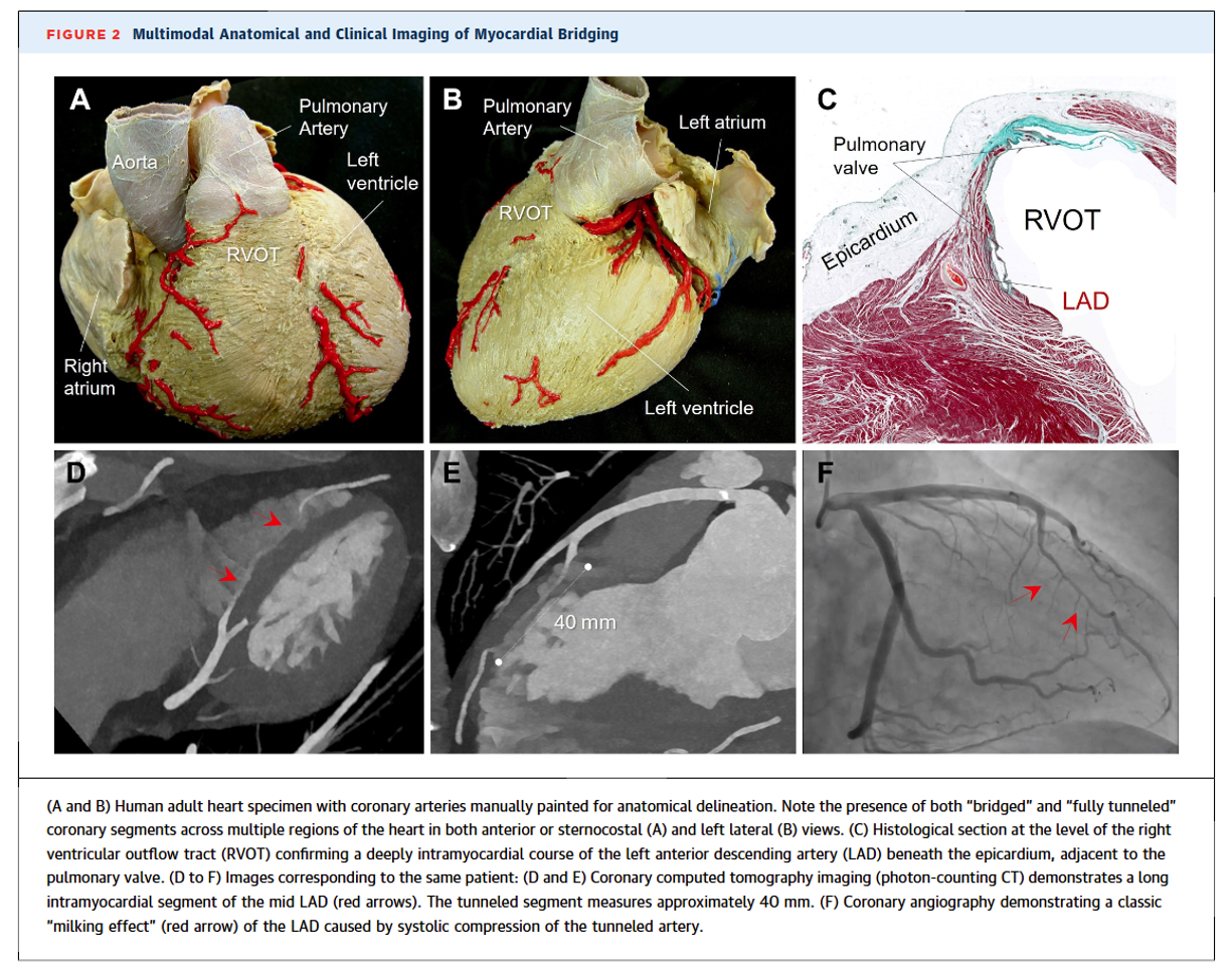 Myocardial bridging - Cardiac Anatomy for Electrophysiologist